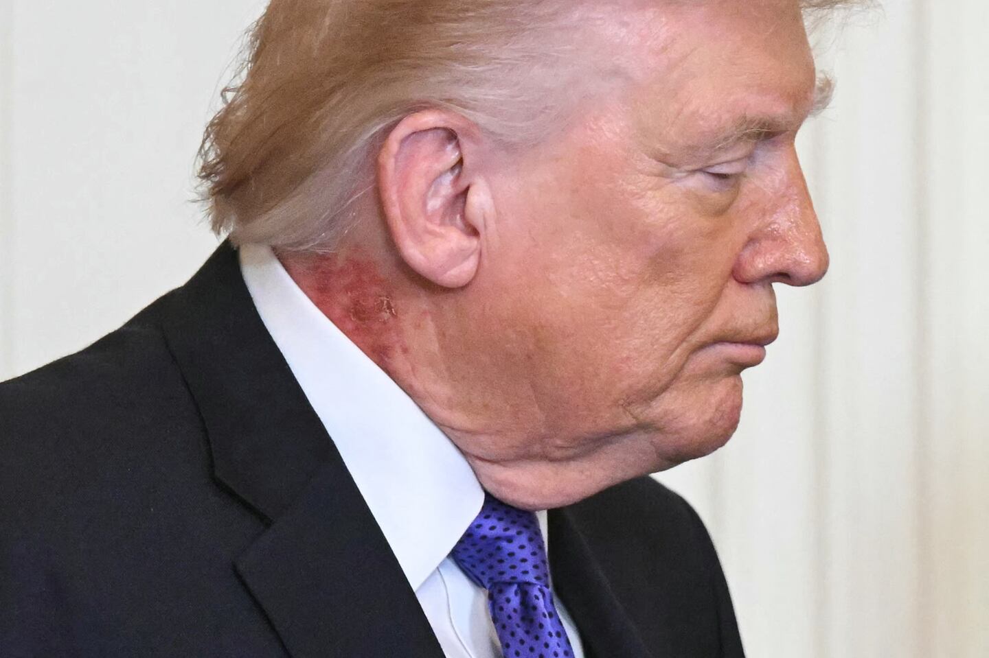 White House Sparks More Questions With Odd Trump Rash Claim