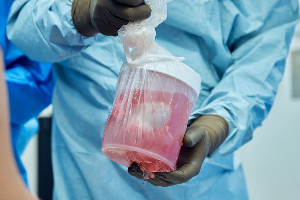 A Gene-Hacked Pig Kidney Has Worked in a Brain Dead Human for a Month