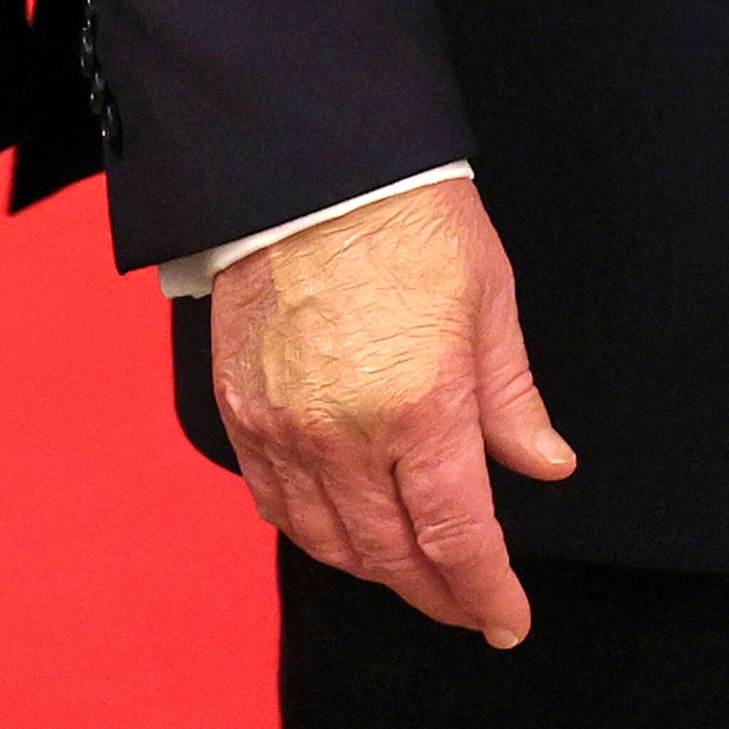 Trump, 79, Slathers Makeup on Bruised Hand But Can’t Hide Neck Rash
