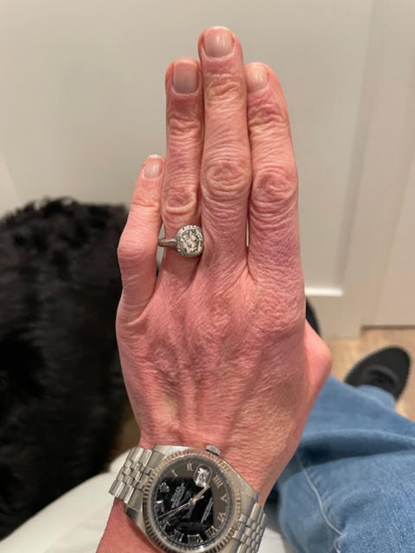 Hand Fillers Made My Hands Look 20 Years Younger—See My Before and After