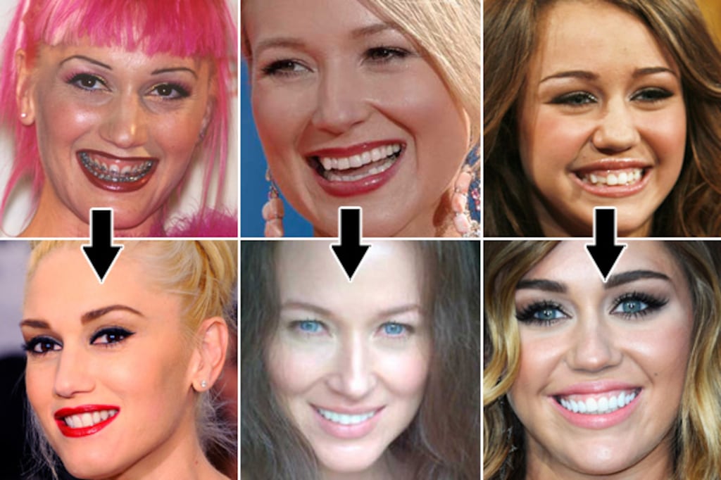 Lindsay Lohan, 50 Cent, Zac Efron and More Stars Who Fixed Their Teeth ...