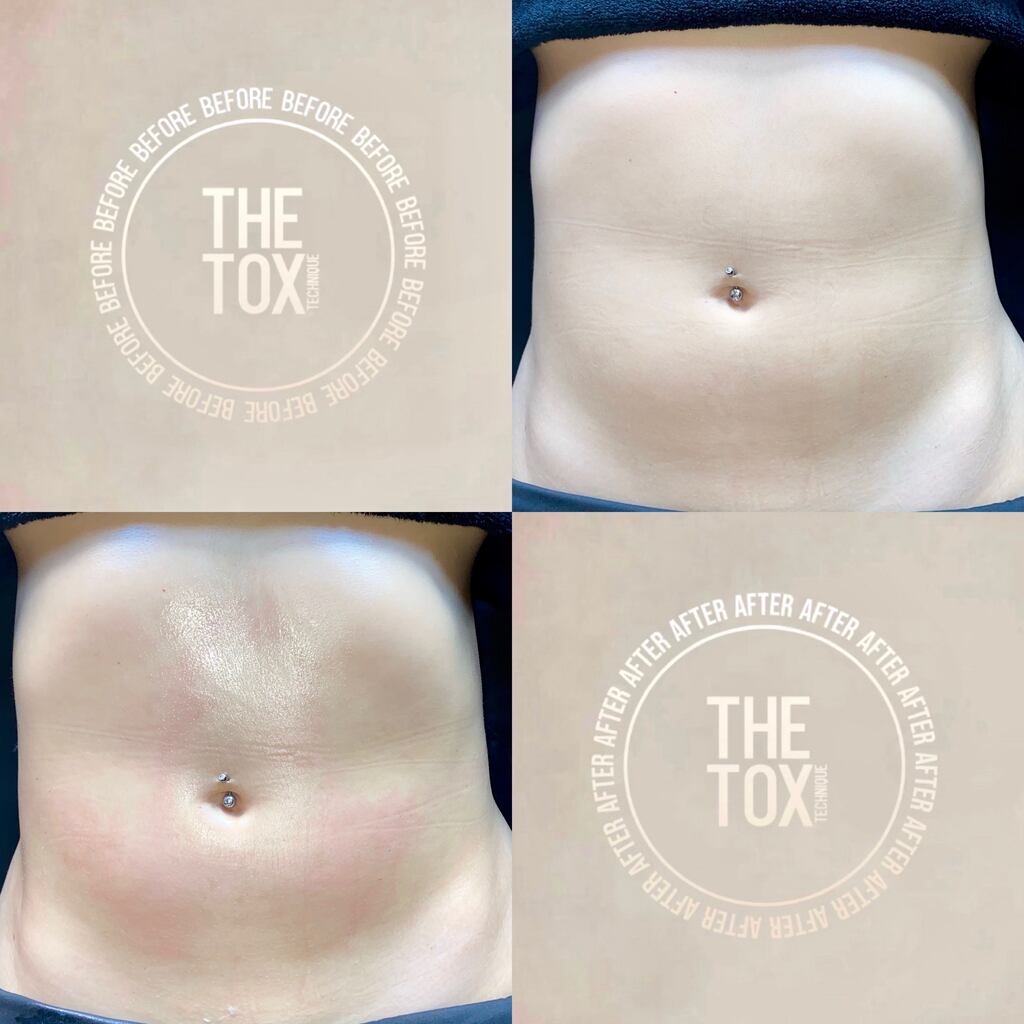 The Tox Lymphatic Drainage Massage Before and After Review