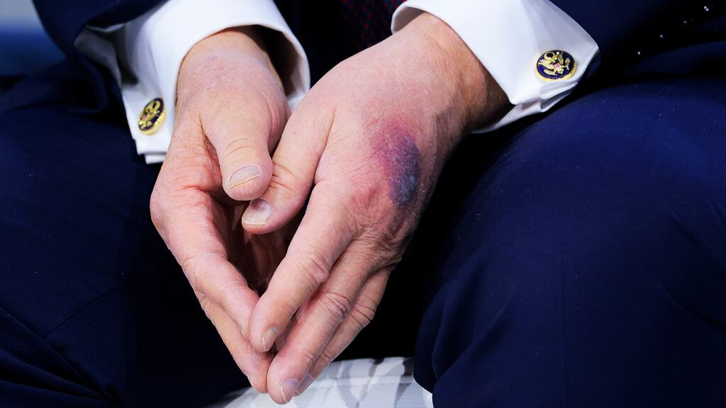 Trump, 79, Downplays Worst Bruising Yet on His ‘Good’ Hand