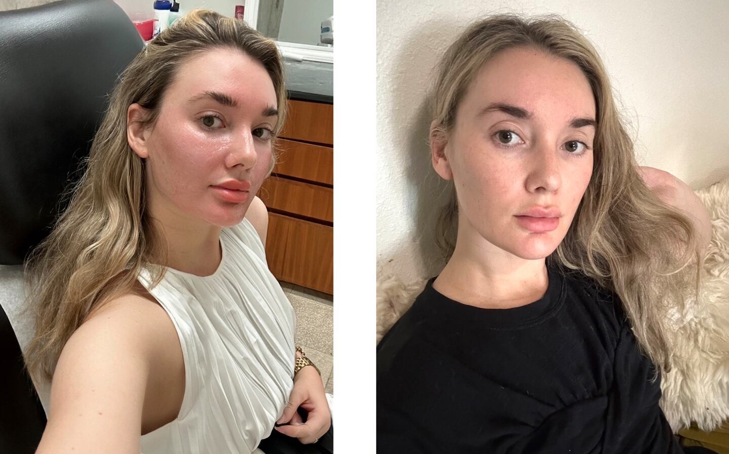 Nefertiti Lift Botox Before and After Review | Scouted, The Daily Beast