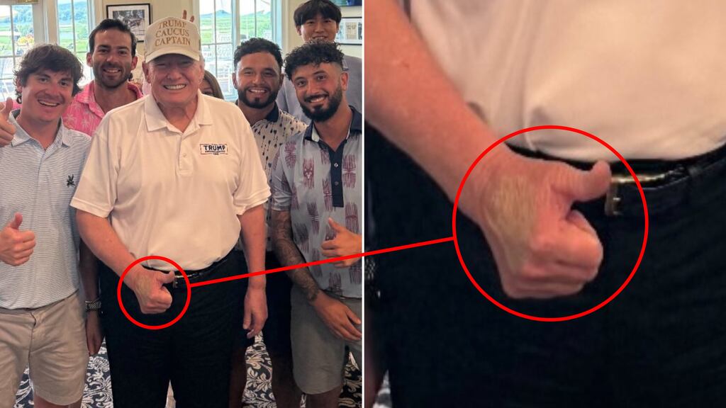 Donald Trump, 79, Spotted With New Bruise on His Other Hand