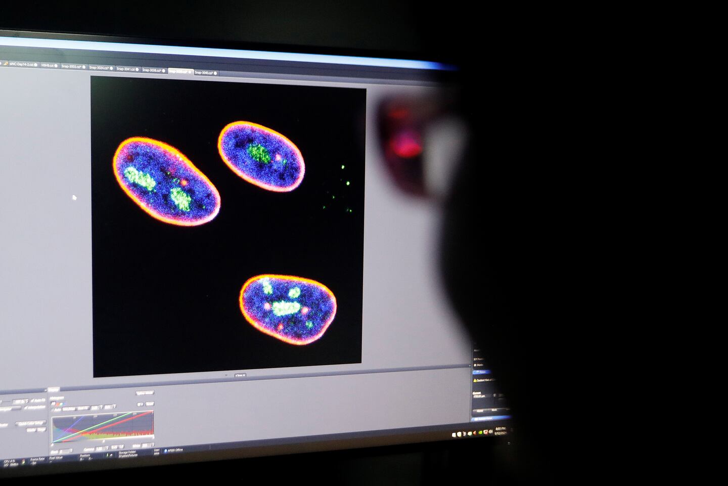 Bone Marrow Mix-Up Led to Leukemia Patient Elizabeth Aloisio’s ...