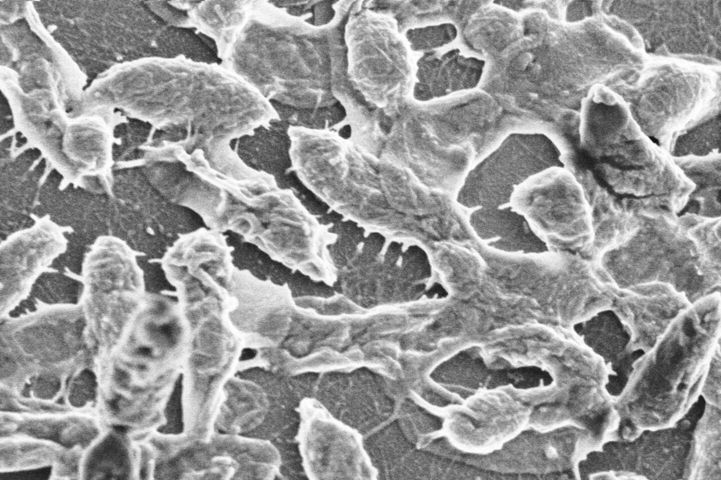 Necrotizing Fasciitis: Life After Flesh-Eating Bacteria
