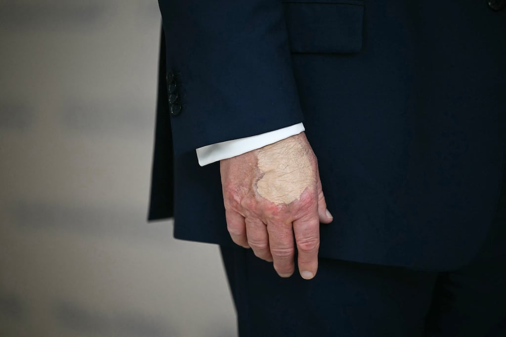 Trump, 79, Smears Right Hand in Makeup Amid Cankles Cover-Up