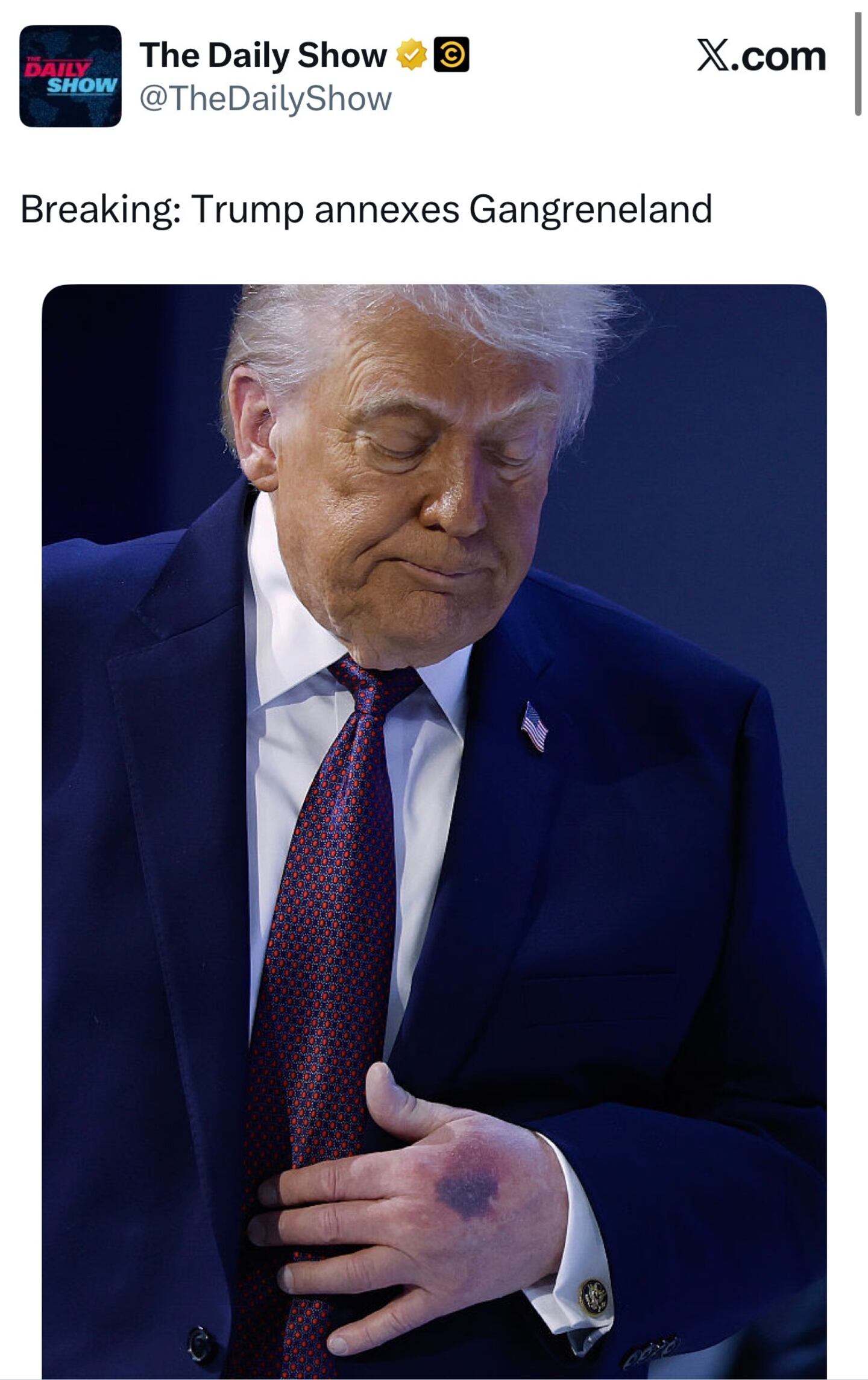 Jon Stewart’s 'Daily Show' Suggests Diagnosis for Trump’s Gnarly Hand ...