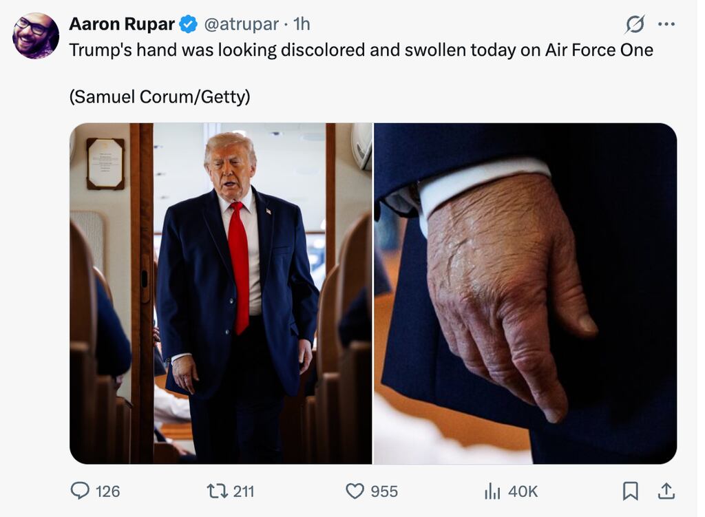Trump’s Battered Hands Spark Fresh Health Concerns After ‘Perfect’ Physical